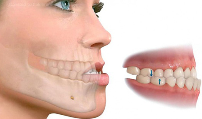 Oclusión y ATM | Clinica Dental Carlos Munguía